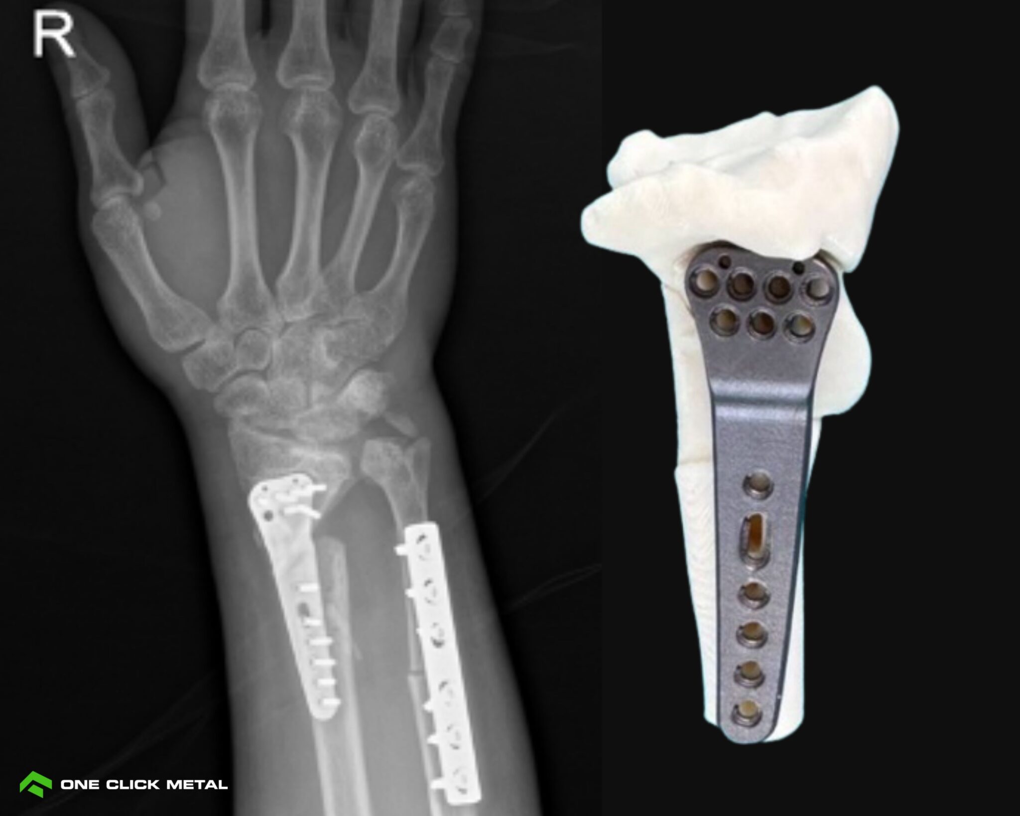 How Metal 3D Printing Is Revolutionizing Medical Implants